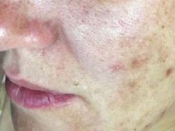 ᐉ Сыпь на лице и шее - КЛИКАЙ СЮДА | VseBani.com.ua